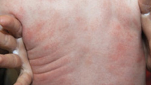 Cow's milk allergy: myth v reality - Danone Nutricia Early Life Nutrition